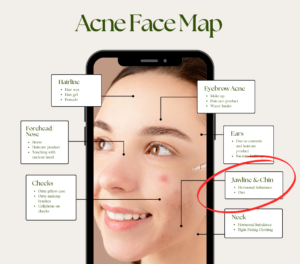 Why Is My Face Breaking Out? Dermatologist-Reviewed Causes & Fixes | Dr ...
